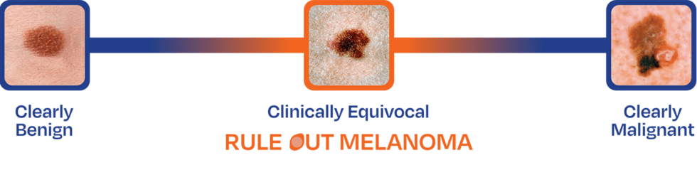 DermTech: Rule Out Melanoma with Precision Genomics